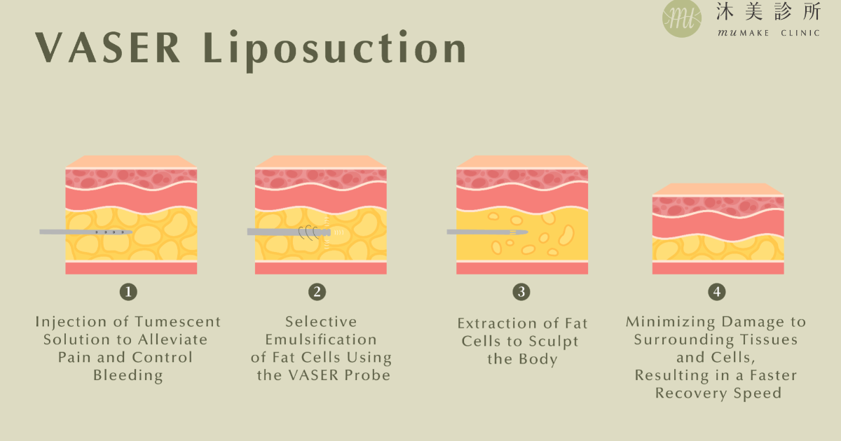 VASER Liposuction - muMAKE CLINIC | muMAKE CLINIC 沐美醫美