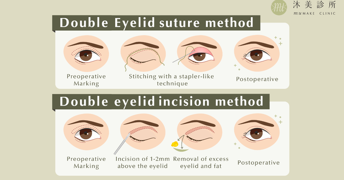 Double eyelid surgery muMAKE CLINIC muMAKE CLINIC